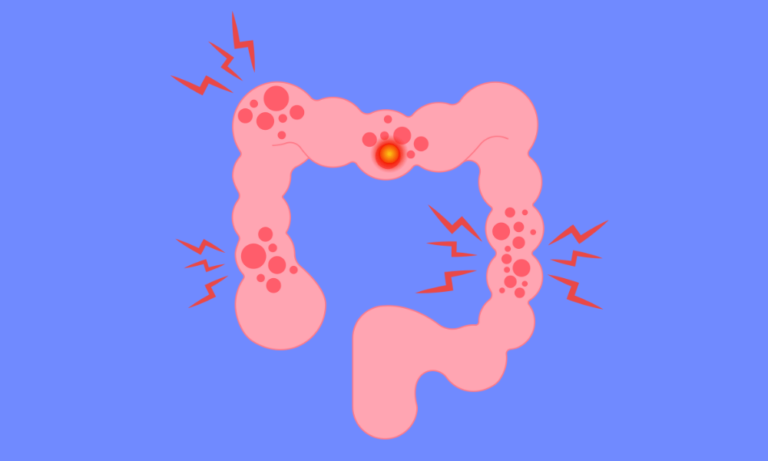 Colon Cancer Treatment In Bangalore Dr Bharath G Oncologist
